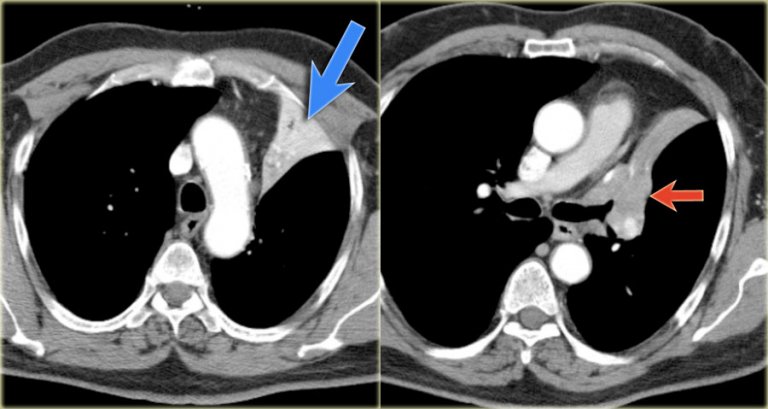 The Radiology Assistant : Chest X-Ray - Lung disease