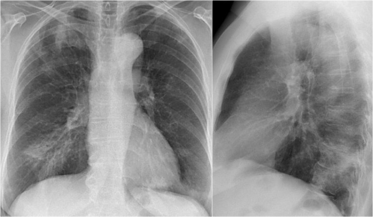 The Radiology Assistant : Chest X-Ray - Lung disease