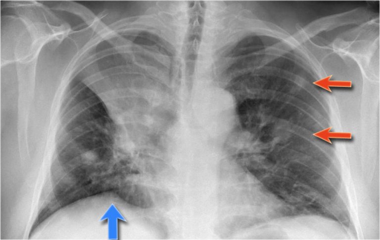 The Radiology Assistant : Chest X-Ray - Lung disease