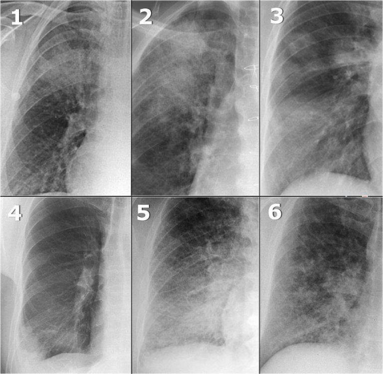 The Radiology Assistant : Chest X-Ray - Lung disease