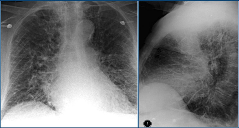 The Radiology Assistant : Chest X-Ray - Lung disease