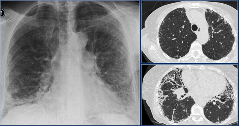 The Radiology Assistant : Chest X-Ray - Lung disease