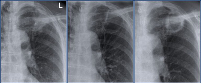 The Radiology Assistant : Chest X-Ray - Lung disease