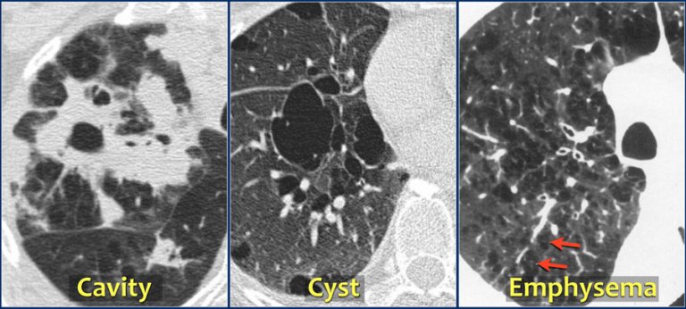 The Radiology Assistant : Chest X-Ray - Lung disease