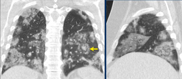 The Radiology Assistant : COVID-19 CO-RADS classification