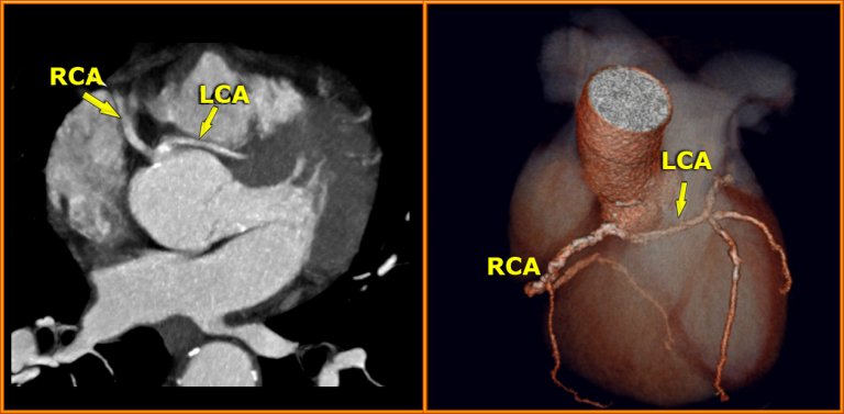 The Radiology Assistant : Coronary anatomy and anomalies
