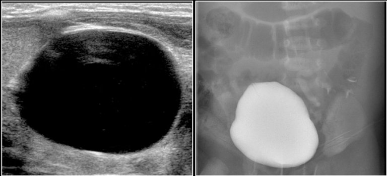 The Radiology Assistant : Cystic Abdominal Masses in Children