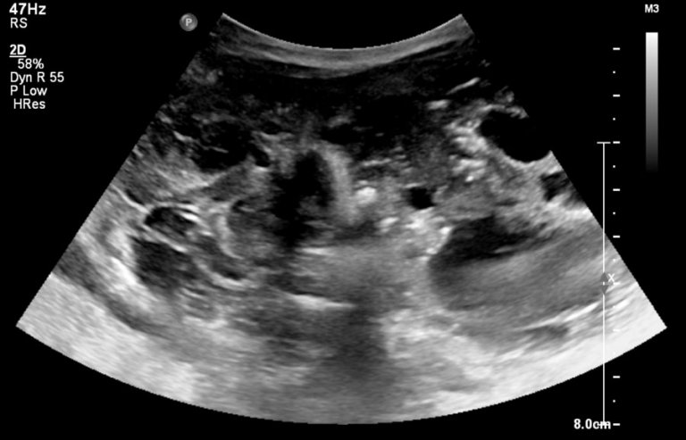 The Radiology Assistant : Cystic Abdominal Masses in Children