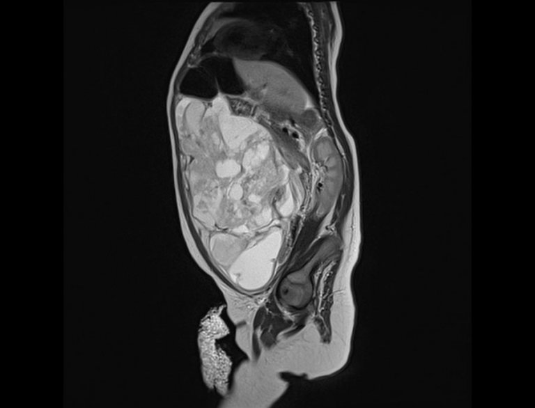 The Radiology Assistant : Cystic Abdominal Masses in Children