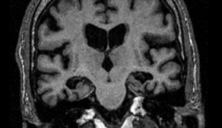 The Radiology Assistant : Brain - Dementia: Role of MRI