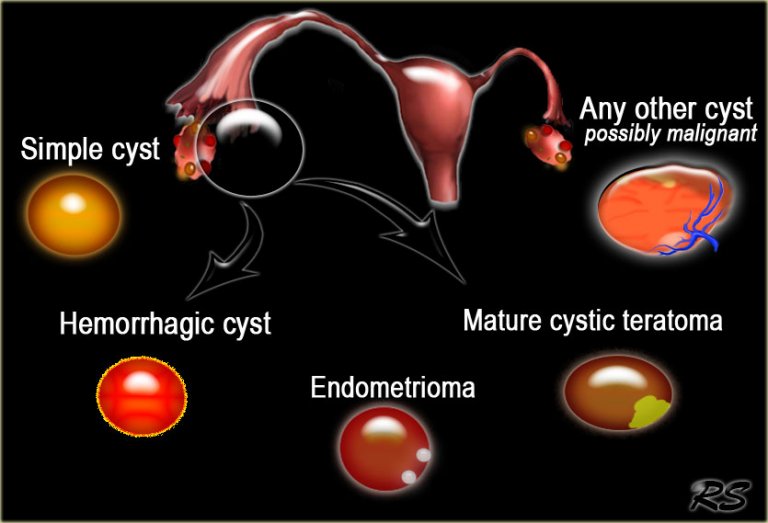 The Radiology Assistant : Roadmap to evaluate ovarian cysts.