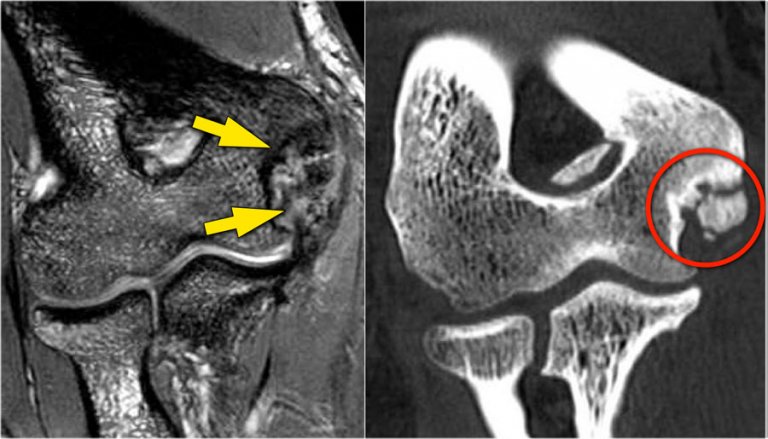 The Radiology Assistant : MRI examination of the Elbow