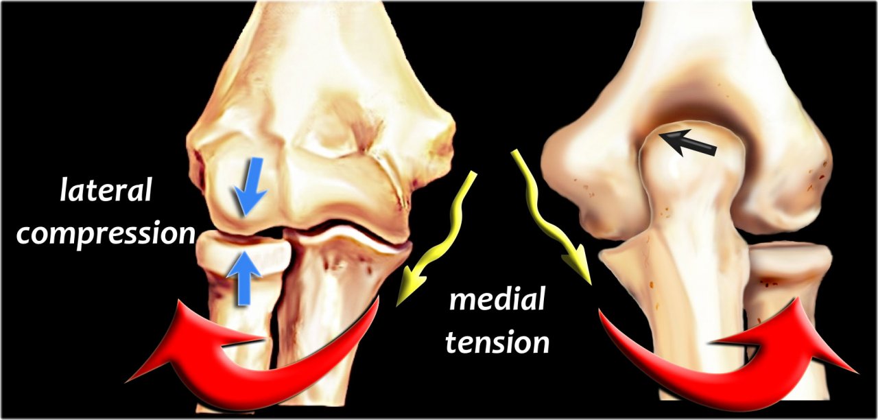The Radiology Assistant : MRI examination of the Elbow