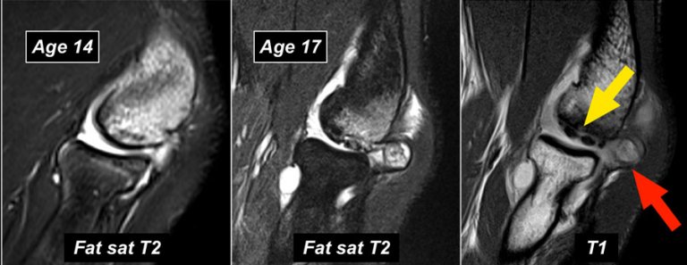 The Radiology Assistant : MRI examination of the Elbow