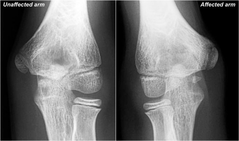 The Radiology Assistant : MRI examination of the Elbow