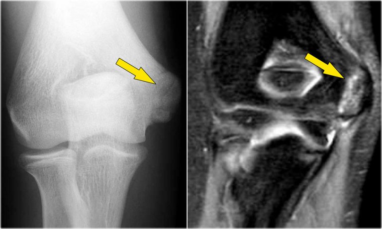 The Radiology Assistant : MRI examination of the Elbow