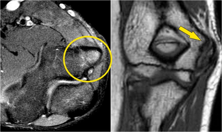 The Radiology Assistant : MRI examination of the Elbow