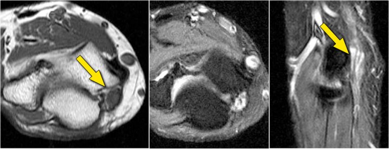The Radiology Assistant : MRI examination of the Elbow