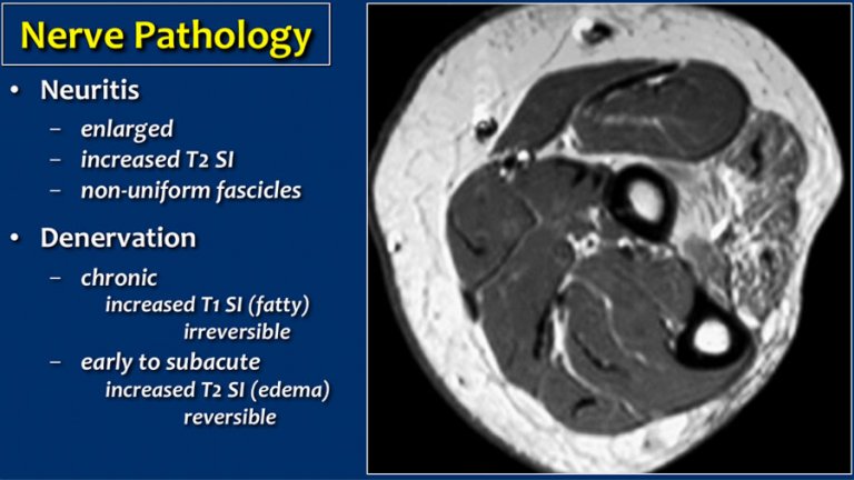 The Radiology Assistant : MRI examination of the Elbow