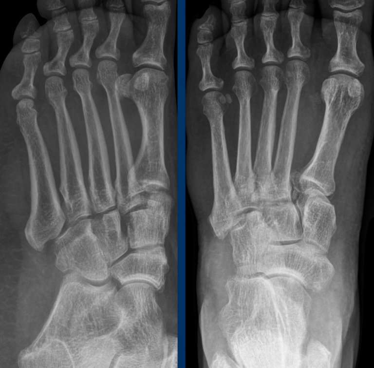 The Radiology Assistant : Foot and Ankle cases