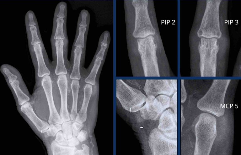 The Radiology Assistant : Arthritis