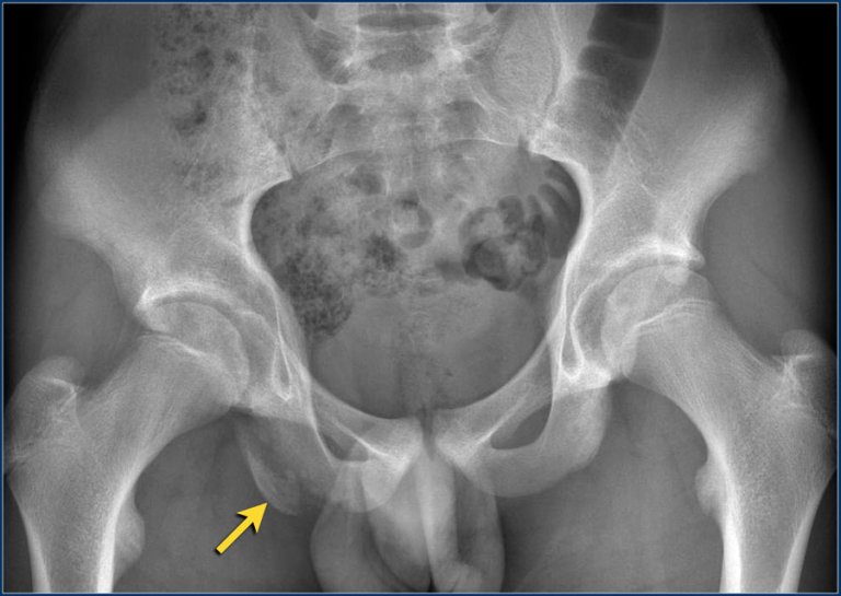 The Radiology Assistant : Hip pathology in Children