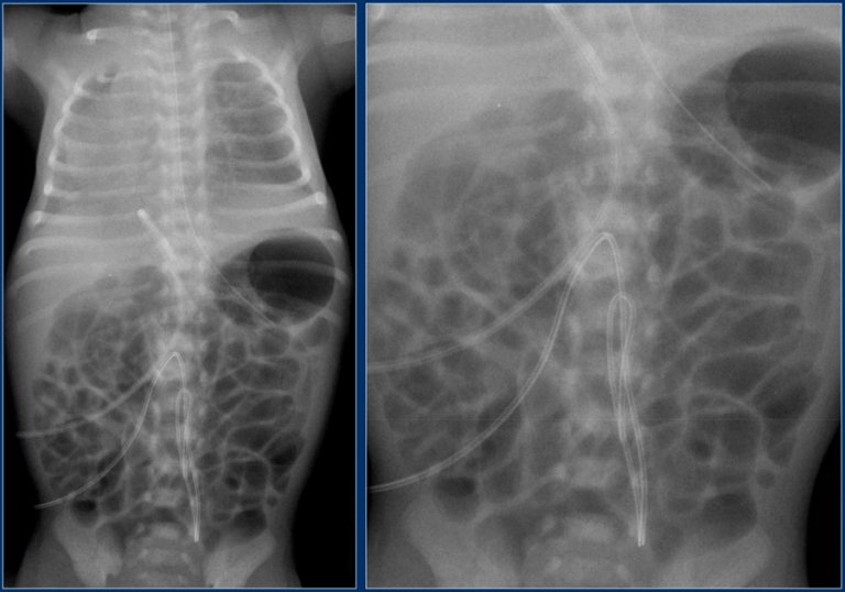The Radiology Assistant : Lines and tubes in Neonates