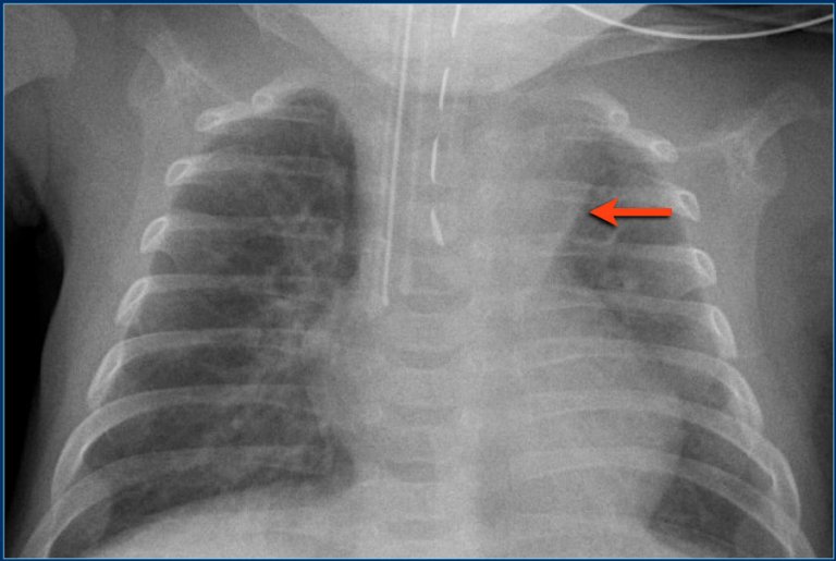 The Radiology Assistant : Lines and tubes in Neonates