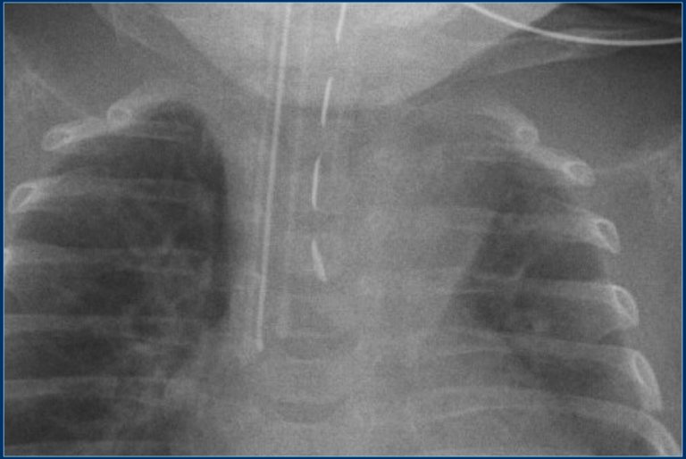The Radiology Assistant : Lines and tubes in Neonates