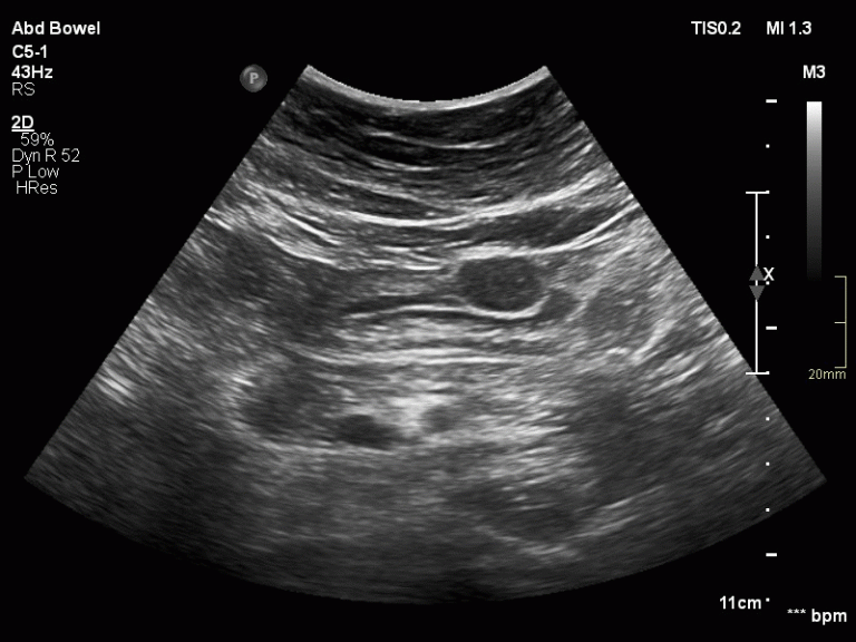 The Radiology Assistant : US of the GI tract - Normal Anatomy