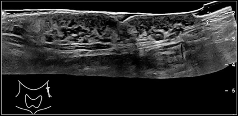 The Radiology Assistant : Neck Masses in Children.