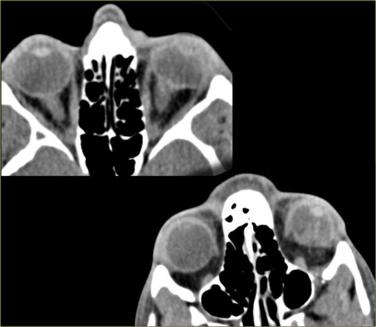 The Radiology Assistant : CT and MRI of the Eye