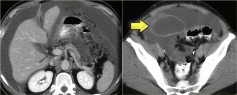 The Radiology Assistant : Peritoneal Pathology
