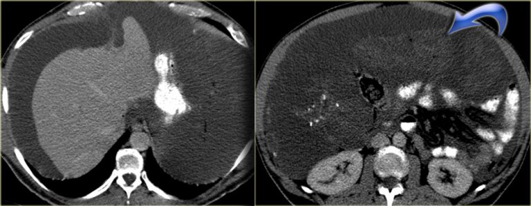 The Radiology Assistant : Peritoneal Pathology
