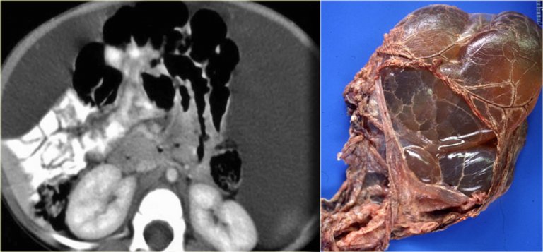 The Radiology Assistant : Peritoneal Pathology