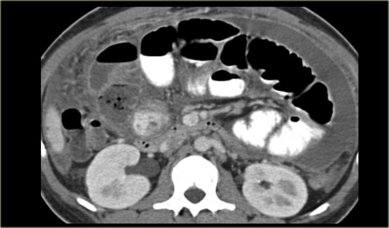 The Radiology Assistant : Peritoneal Pathology