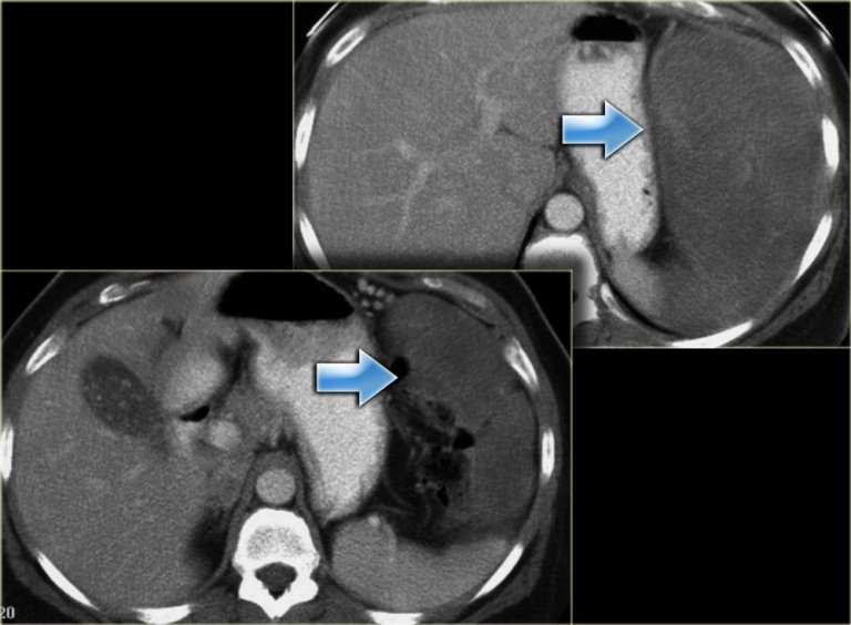 The Radiology Assistant : Peritoneal Pathology