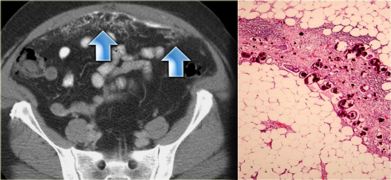 The Radiology Assistant : Peritoneal Pathology