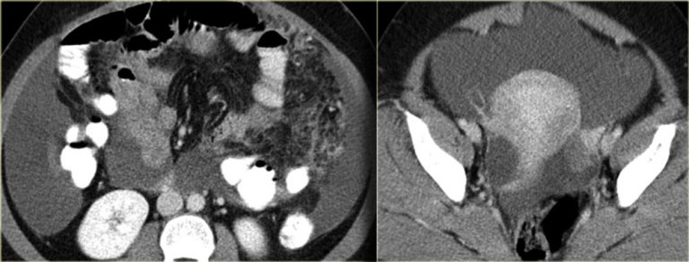 The Radiology Assistant : Peritoneal Pathology