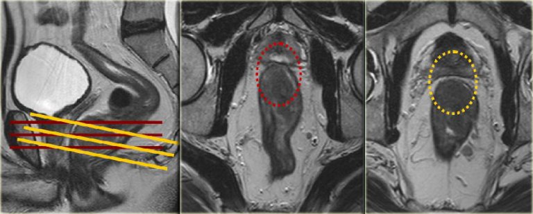 The Radiology Assistant : Rectal Cancer MR staging 3.0