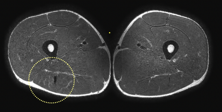 The Radiology Assistant : Hamstring injury