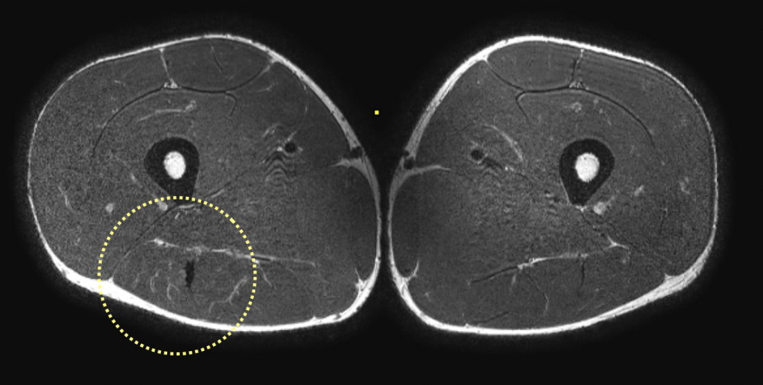 The Radiology Assistant : Hamstring injury