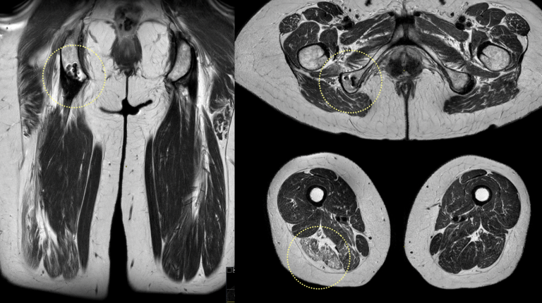 The Radiology Assistant : Hamstring injury