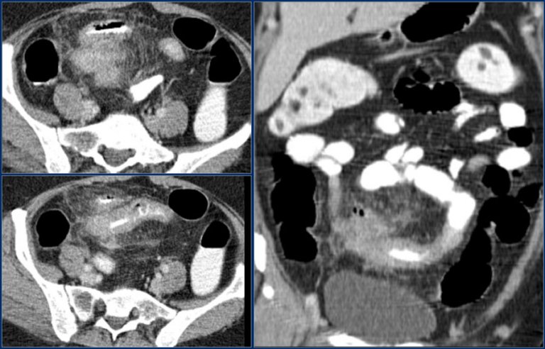 The Radiology Assistant : Small Bowel Tumors