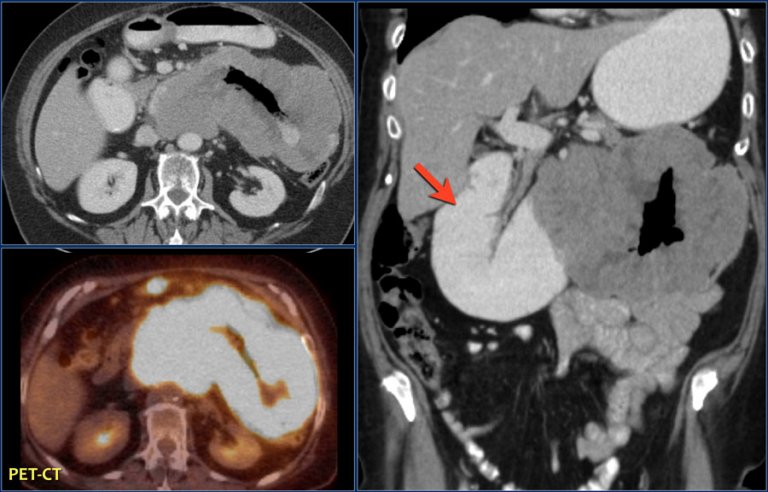 The Radiology Assistant : Small Bowel Tumors