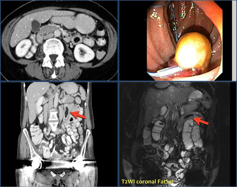 The Radiology Assistant : Small Bowel Tumors