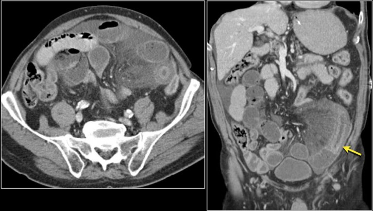The Radiology Assistant : Small Bowel Tumors