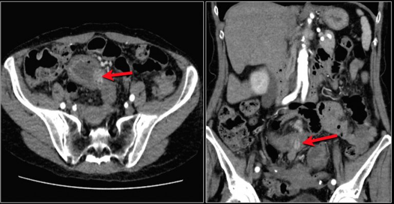 The Radiology Assistant : Small Bowel Tumors