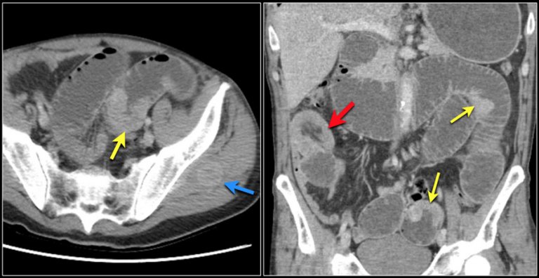 The Radiology Assistant : Small Bowel Tumors