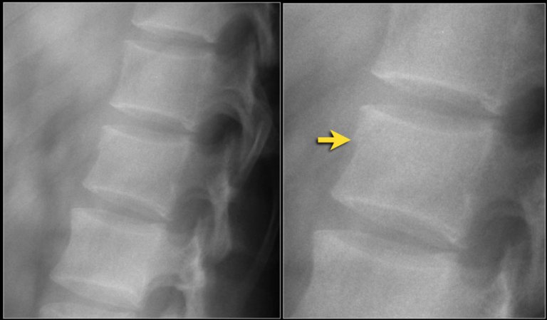 The Radiology Assistant : TLICS Classification of fractures